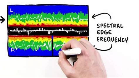 Brand Masimo Root With Sedline Bis Patient Monitoring System Display