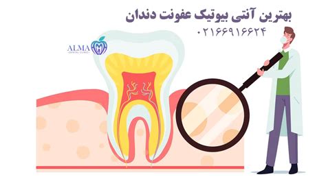 بهترین آنتی بیوتیک عفونت دندان درمان عفونت دندان و لثه