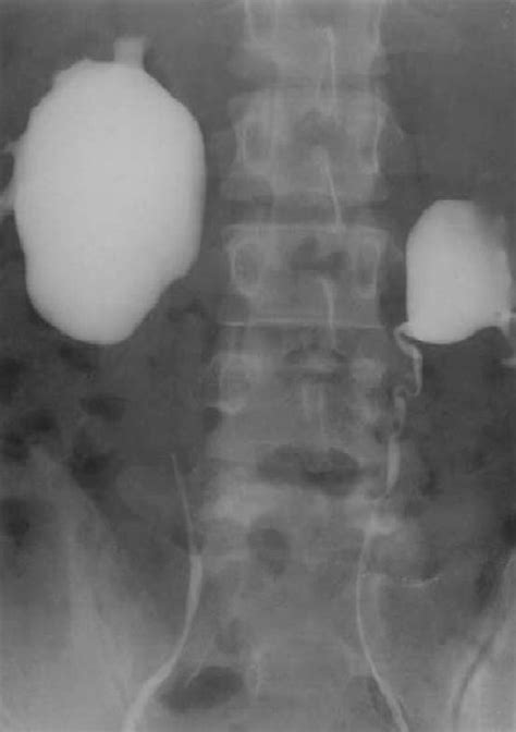 Bilateral Retrograde Pyelography Indicates Bilateral Ureteropelvic