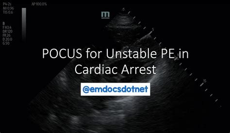 Emergency Medicine Educationpocus Findings Of