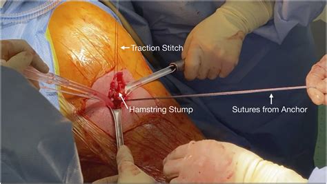 Proximal Hamstring Repair An Overview Of Anatomy Indications And Techniques Journal Of