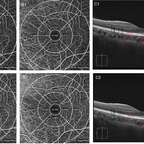 Optical Coherence Tomography Angiography Octa Analysis Results In Download Scientific Diagram