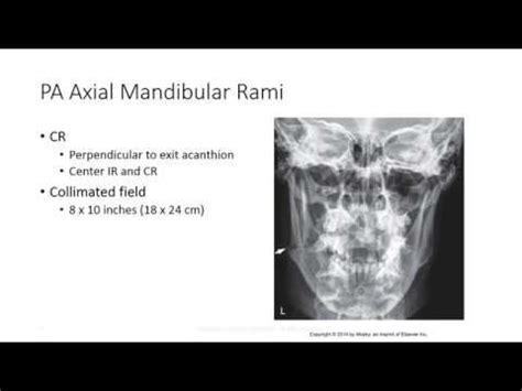 Ramus Of Mandible Radiology