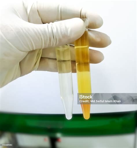 실험실 기술자는 분석을 위해 2개의 소변 샘플 튜브를 보유하고 있으며 하나는 정상적인 보관 색상 소변 샘플이고 다른 하나는 침전물 샘플 충분한 고름 세포 클로즈업이 있는