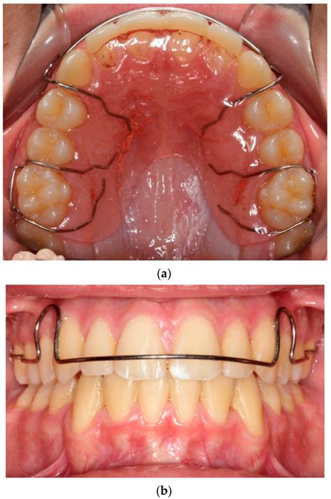 Orthodontic Retainers—a Critical Review