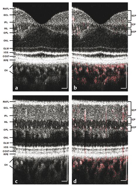 4 Phase Variance Optical Coherence Tomography Ento Key
