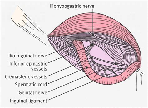Anatomia Da Hernia Inguinal Pediatric Inguinal And Femoral Groin