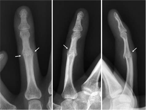 Plain Radiographs Of The Left Fourth Digit Reveal Cortical Irregularity