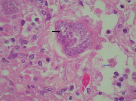 Thyroid Gland Granuloma Containing Numerous Large Yeasts With