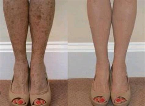 Thyroid Problems And Pigmentation Drkavitha Dev