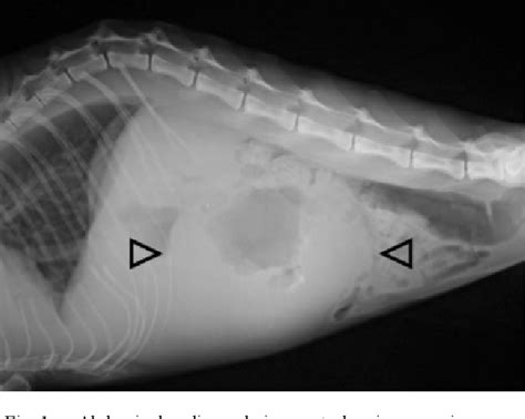 Figure 1 From Megaesophagus Was Complicated With Billroth I