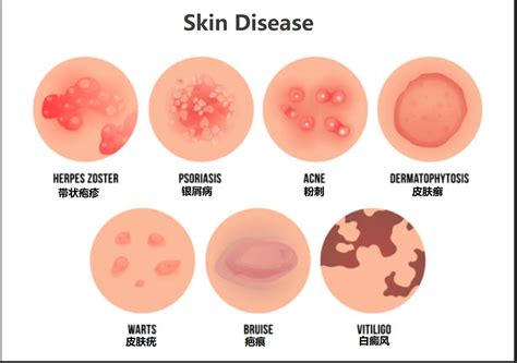 Skin Disease Jian Cui－纽约 最好的 医美 美容 皮肤科 医生 皮肤病 皮肤 美容科 过敏 科 专科 皮肤病科 医生