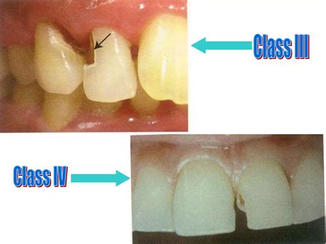 Dental Caries Classificationppt