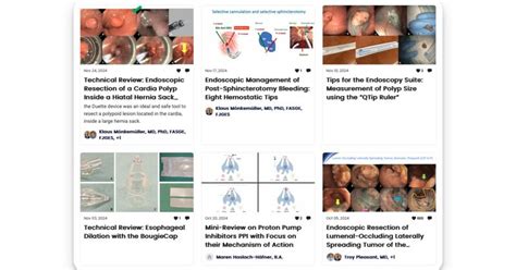 The Practicing Endoscopist On Linkedin The Esd Emr Hybrid Or Pre Cutting Emr Endoscopic