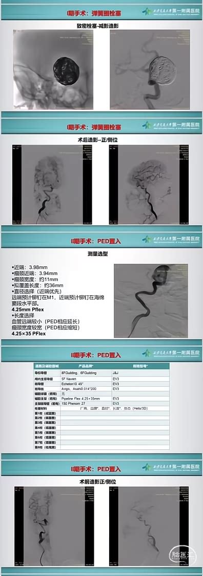 谢万福教授团队手术分享第8期：密网支架 Pipeline Flex 治疗巨大动脉瘤 脑医汇