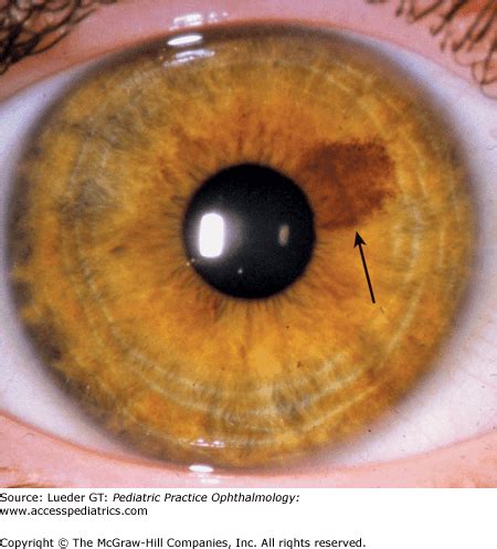 Abnormal Pupil Shape Cogan Reese Syndrome An Iris Melanoma