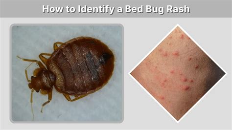 Bed Bug Rash Symptoms Pictures Causes And Treatment
