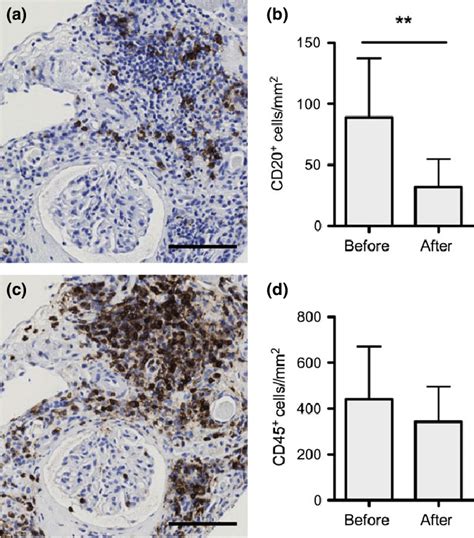 A Representative Cd20 Staining B Allograft Cd20 Positive Cells