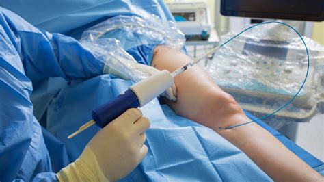Recomendaciones Previas A La Operación De Varices Safenectomía
