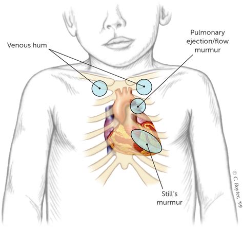 confused about locations of heart murmurs in r step1 51 off