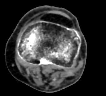 How To Use ITK To Segment Bones In Osteoporotic Patients Algorithms ITK
