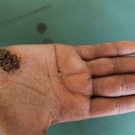 Palmar Keratoderma Pits And Ulcerations Covered By Thick And Download Scientific Diagram