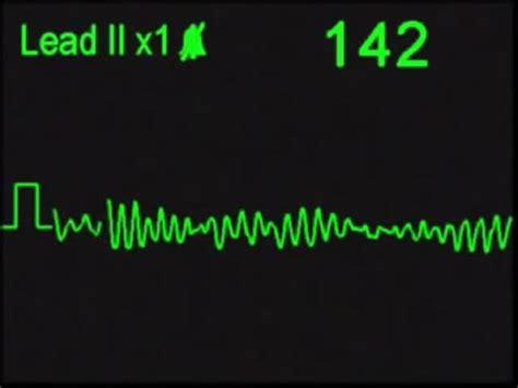 Ventricular Fibrillation Ecg Ecg Case 150 Atrial Fibrillation With