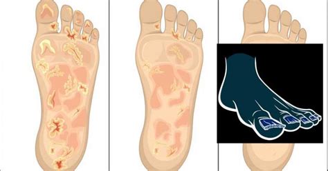 Гъбички по краката природни методи за неутрализиране на действието им Здраве Орг