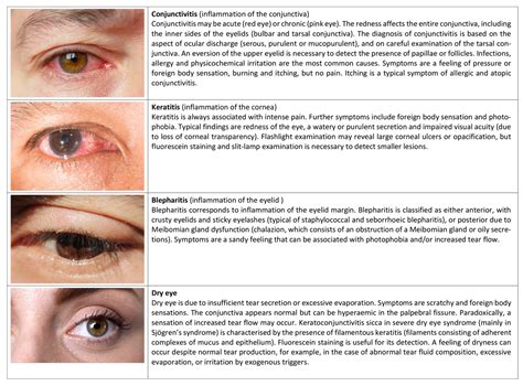 Management Of Dupilumab Associated Ocular Surface Diseases In Atopic