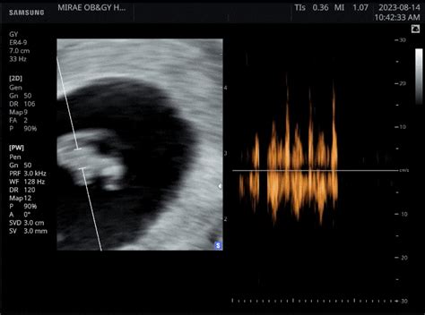 임신 일기 5주차~7주차 난황 심장소리 입덧시작 임밍아웃 분만병원 정하기 네이버 블로그
