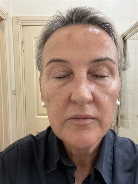 Hyperpigmentation Vs Hypopigmentation Explained U Skin Clinics