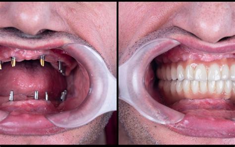 Full Mouth Dental Implants Restoring Your Oral Health