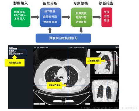 基于深度学习的ct图像肺结节自动检测技术（行业及技术分析） 深度学习进行肺结节识别的过程 csdn博客