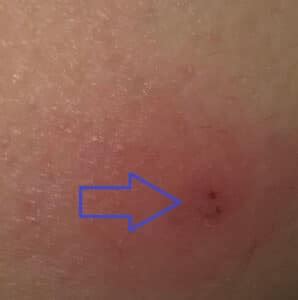 Camel Spider Bite Symptoms And Treatment With Pictures