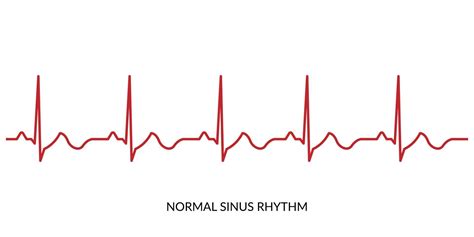 Normal Heartbeat Ekg
