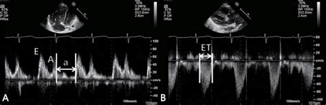 measurement of right ventricular rv myocardial performance index