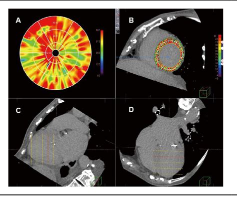 Representative Case Of Extracellular Volume Fraction Ecv Analysis Of Download Scientific