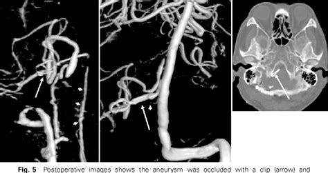 Figure 5 From A Case Of Subarachnoid Hemorrhage Due To Intracranial Anterior Spinal Artery