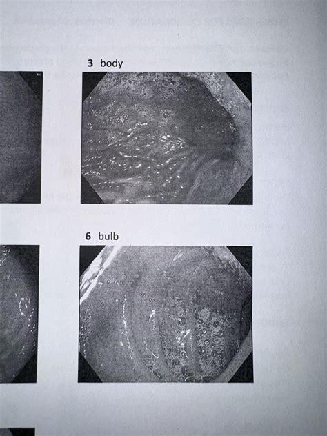 Egd Procedure Report Rmedicaladvice