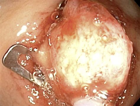 Pseudo Polyp Resection Download Scientific Diagram