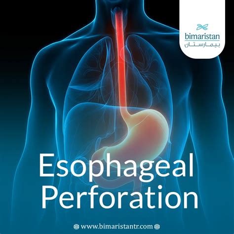 Esophageal Perforation Diagnosis And Treatment In Turkey