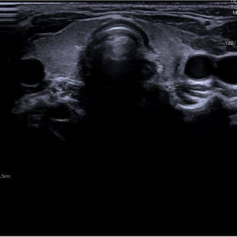 Thyroid Gland Assimetry With Hypoplasia Of The Left Lobe And Structural Download Scientific