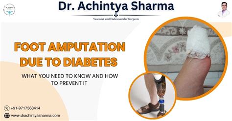 How Diabetes Can Cause Foot Amputation Know How To Prevent It