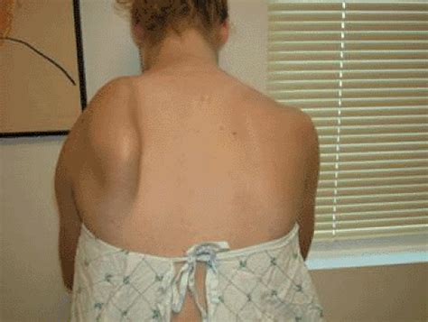 Scapulothoracic Dysfunction Burners Stingers Thoracic Outlet