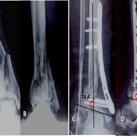 Measurement Of Lateral Distal Tibial Angle Ldta And Length Of Lateral