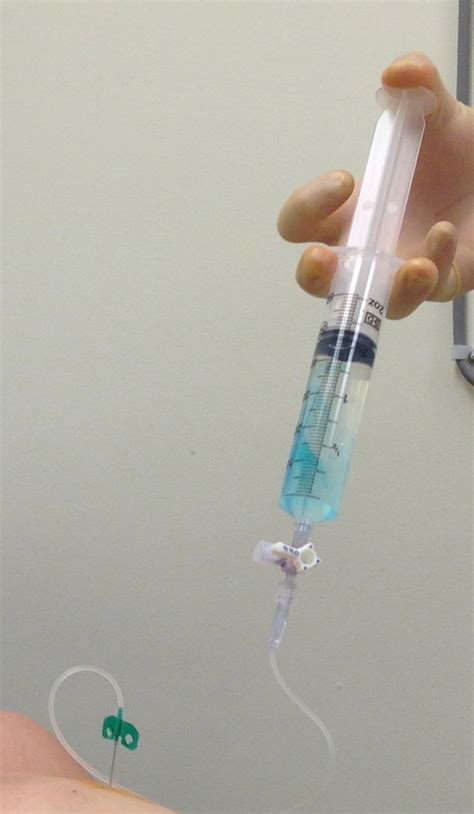 My Journey With Brca1 The Wonderful World Of Tissue Expanders
