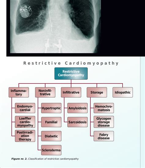 Figure Nr 1 Chest Radiograph With Implanted Dualchamber Pacemaker And Download Scientific