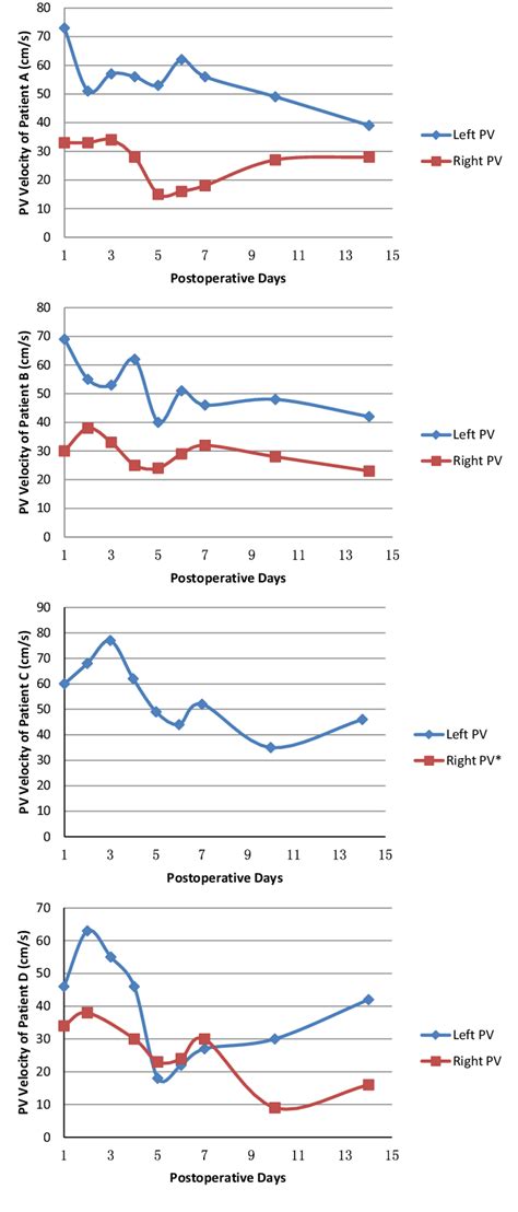 Dynamic Pv Peak Velocity Of Left Pv And Right Pv In Patients A B C