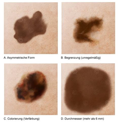 Hautkrebs Symptome Tabelle Gutartiger Hautkrebs Bilder Evzgx