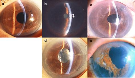 Iris Damage Grading We Classified The Iris Damage Into Four Grades As
